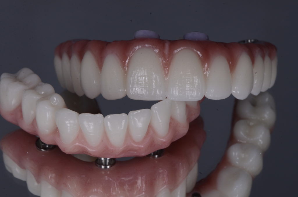 All-on-4® | Digital Dental Arts Laboratory